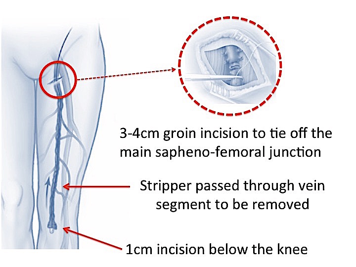 Surgical Ligation Stripping Varicose Veins Dr Avinash Katara Minimal Surgical Ligation Stripping Varicose Veins Dr Avinash Katara Minimal